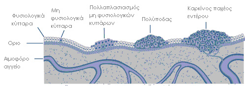 Χειρουργική παχέος εντέρου - Μιχάλης Λ. Λορεντζιάδης - MD, PhD, FISS ...